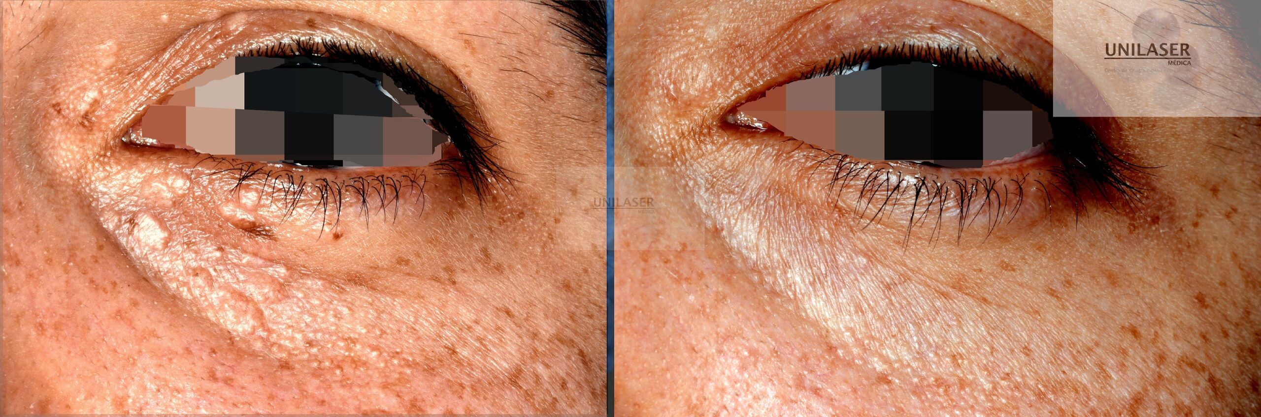 Eliminación de Siringomas con láser con Láser- UNILASER MÉDICA