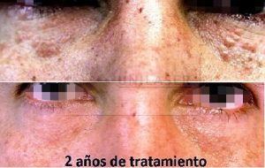 Eliminación de Siringomas con láser con Láser- UNILASER MÉDICA