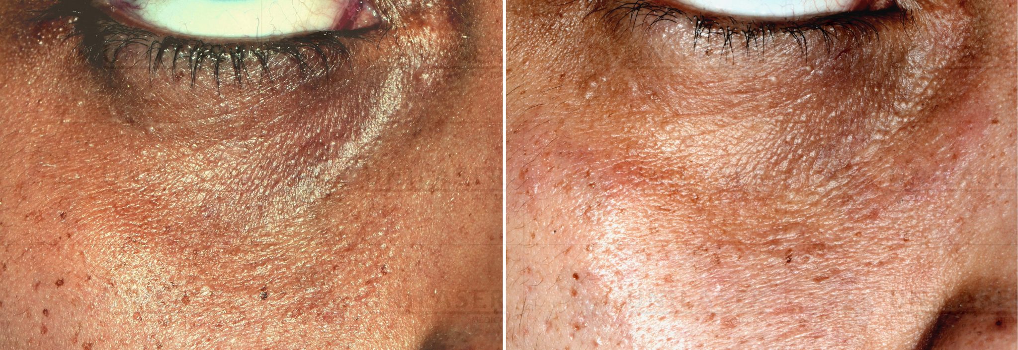 Eliminación de Siringomas con láser con Láser- UNILASER MÉDICA