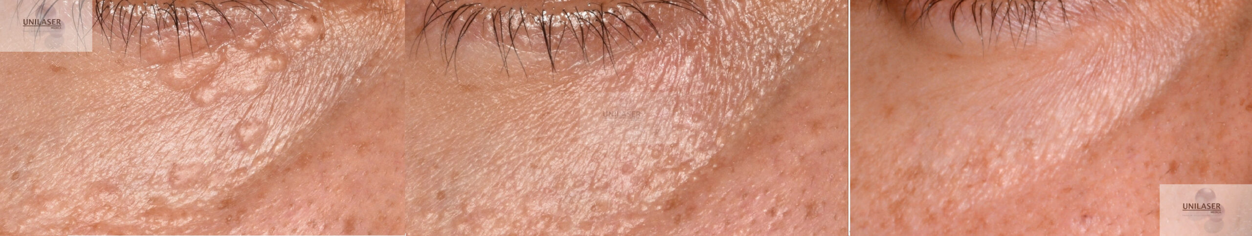 Eliminación de Siringomas con láser con Láser- UNILASER MÉDICA