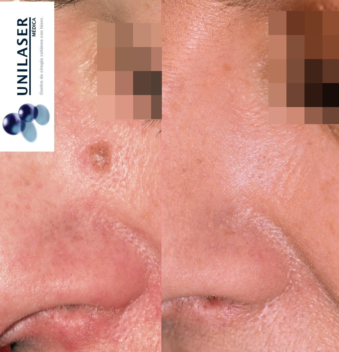 Visual Aid for Laser Procedure Pricing for Skin Tumors – UNILASER MÉDICA