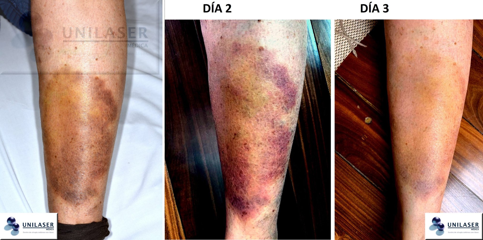Lámpara Aktilite para eliminar hematomas – UNILASER MÉDICA